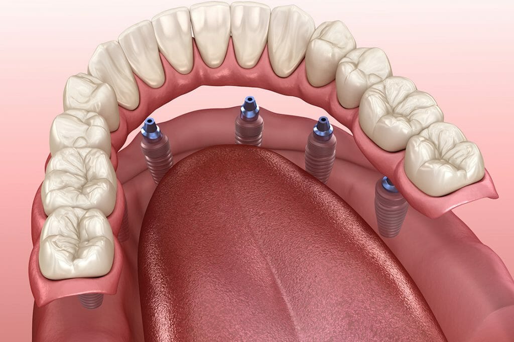 Get a Secure Fit With Implant Supported Dentures in Cincinnati