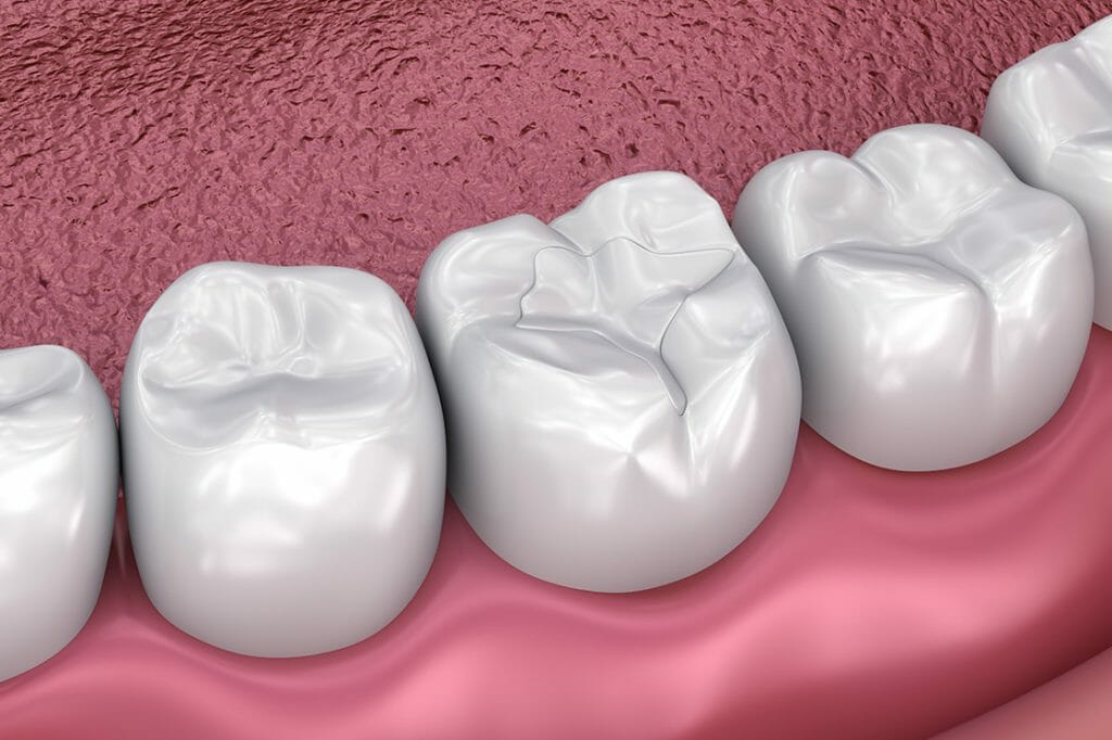 Protect Your Teeth With Dental Sealants in Hyde Park